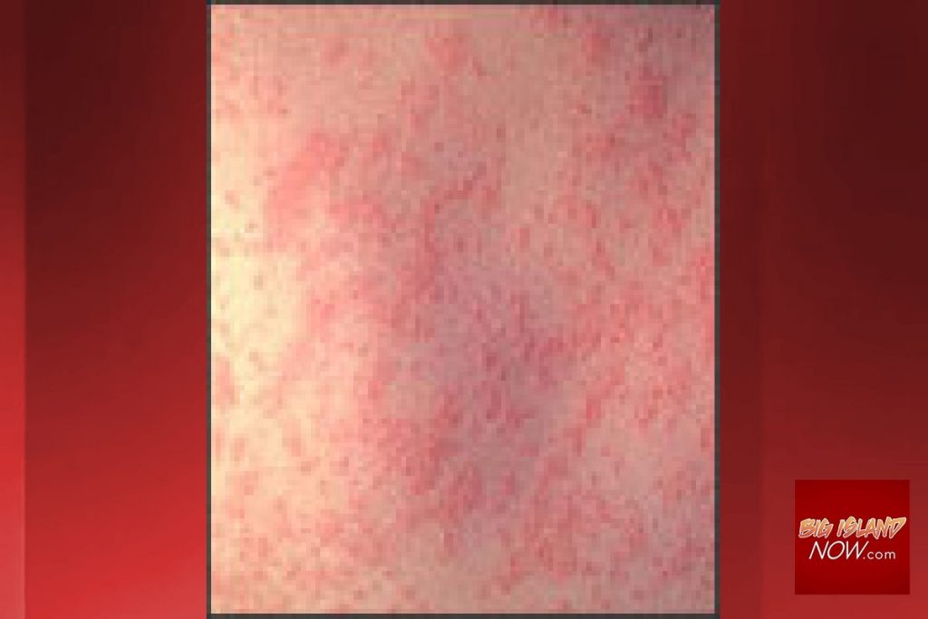Second measles case identified on O‘ahu : Kauai Now